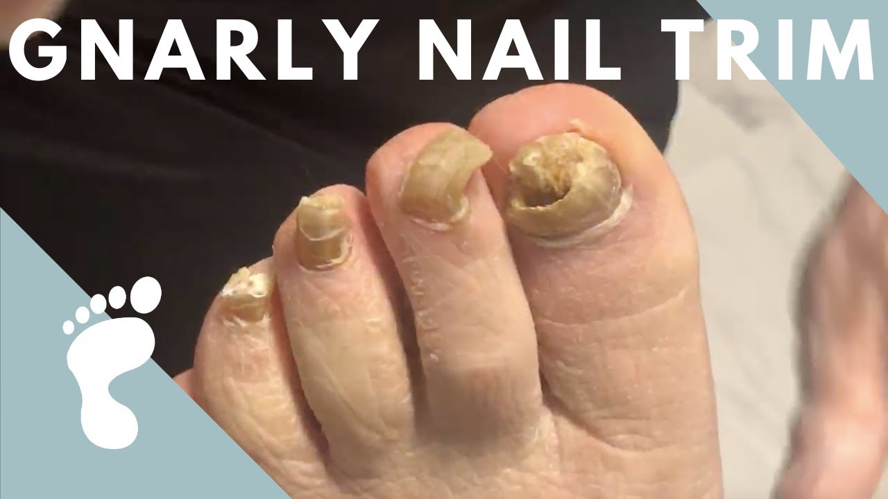 FUNGAL NAIL TRIM - YouTube