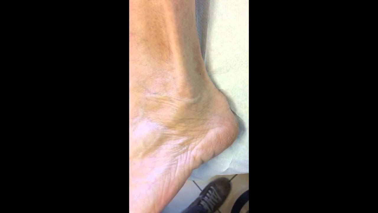 peroneal tendons dislocation, lussazione tendini peronieri, luxación de ...