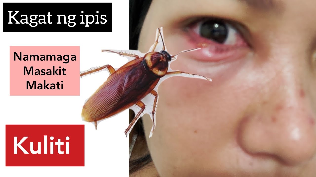 Kagat ng ipis sa mata o Kuliti | My experience - YouTube