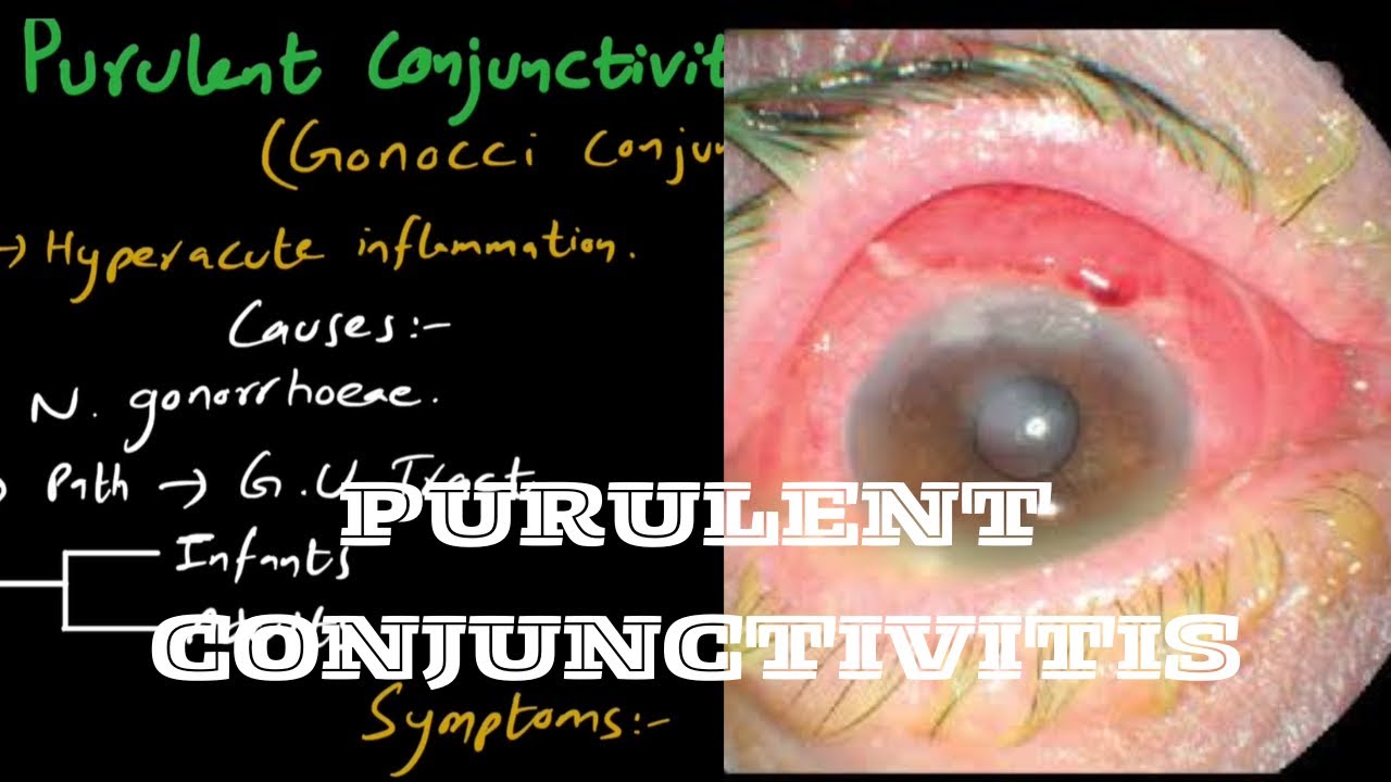 PURULENT CONJUNCTIVITIS | Hyperacute bacterial CONJUNCTIVITIS | Gonococci CONJUNCTIVITIS - YouTube