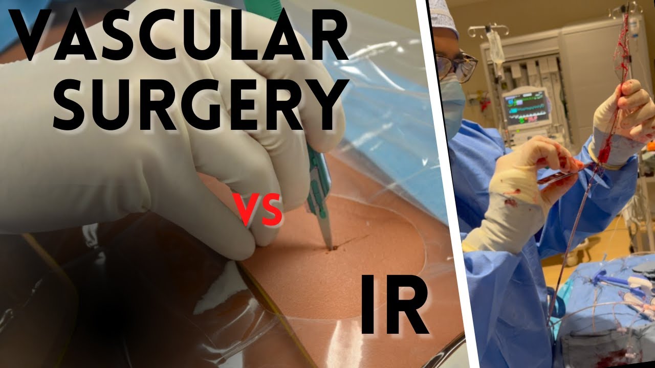 Vascular Surgery or Interventonal Radiology - YouTube