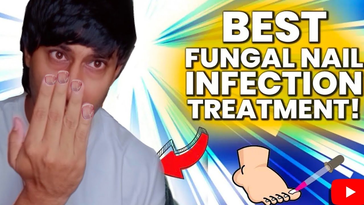 NAKHUN MAI NAIL FUNGUS HO GYA😭|Nail fungus treatment|Nail fungus ...