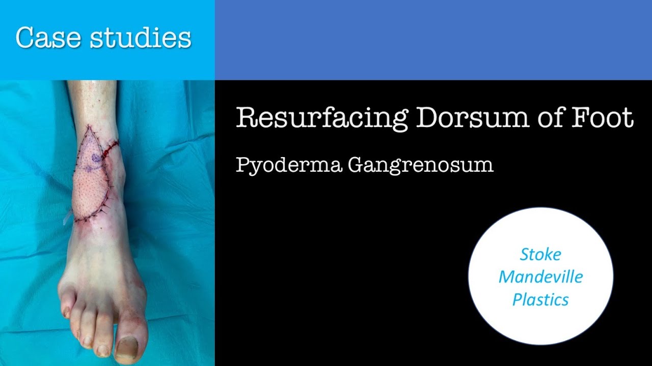Flap reconstruction for Pyoderma Gangrenosum on Dorsum of Foot - YouTube