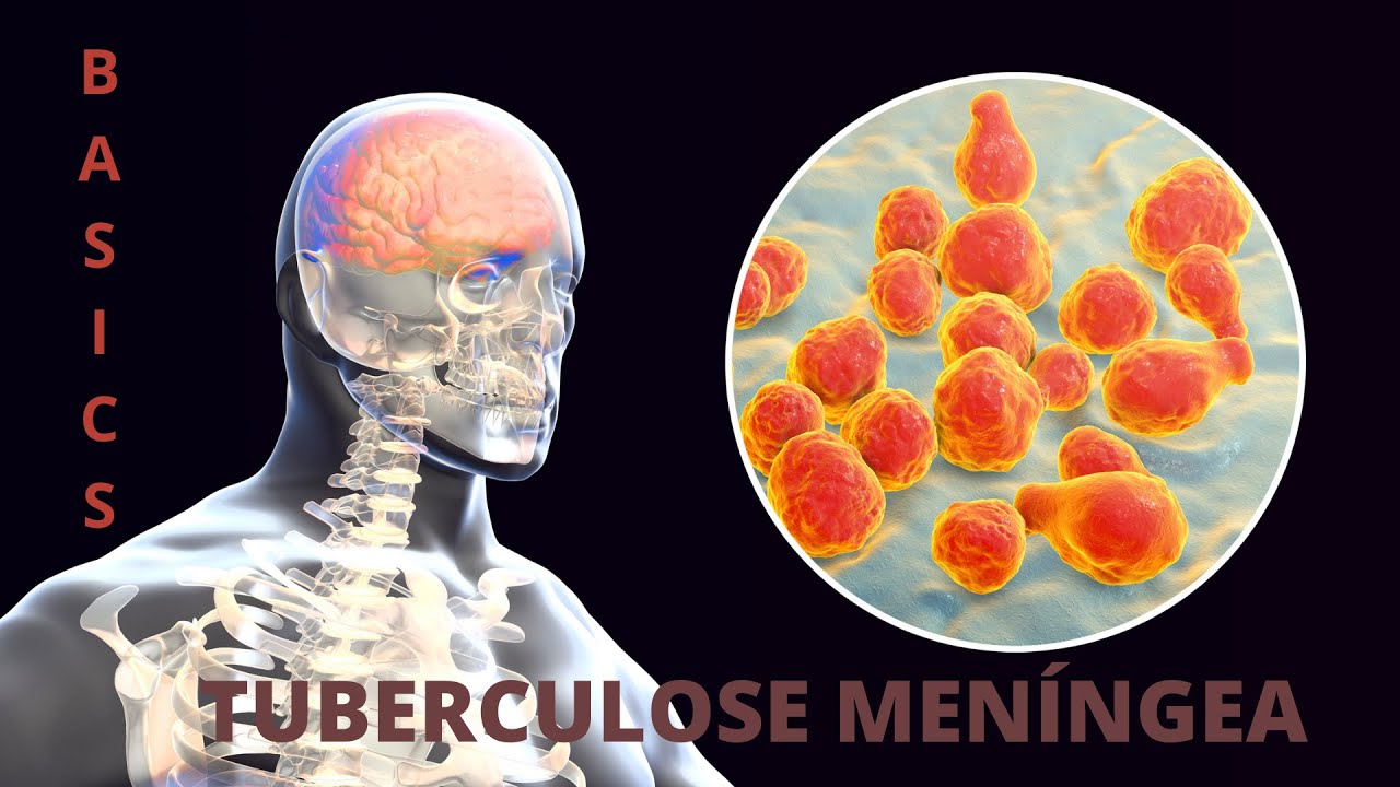 TUBERCULOSE MENÍNGEA E SUAS COMPLICAÇÕES - YouTube