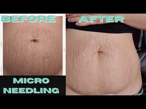 I Got Professional Microneedling Done on my Stretch Marks! (Results and ...