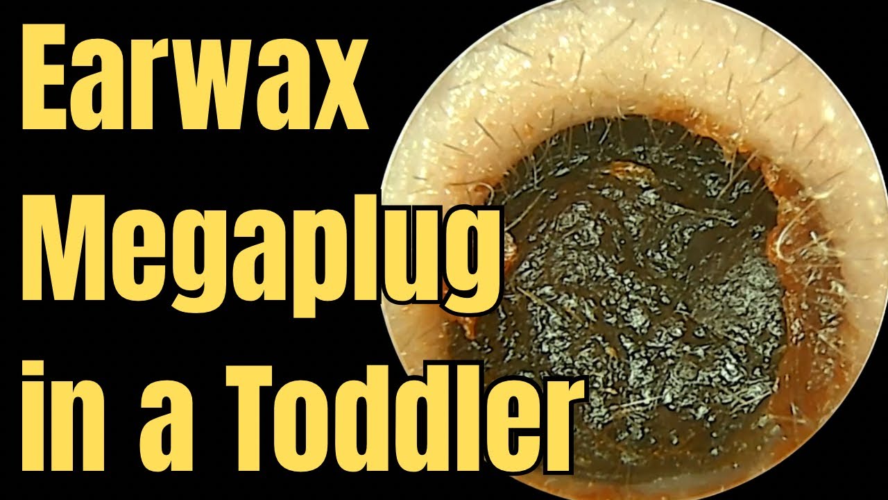 Earwax Megaplug in a Toddler - YouTube