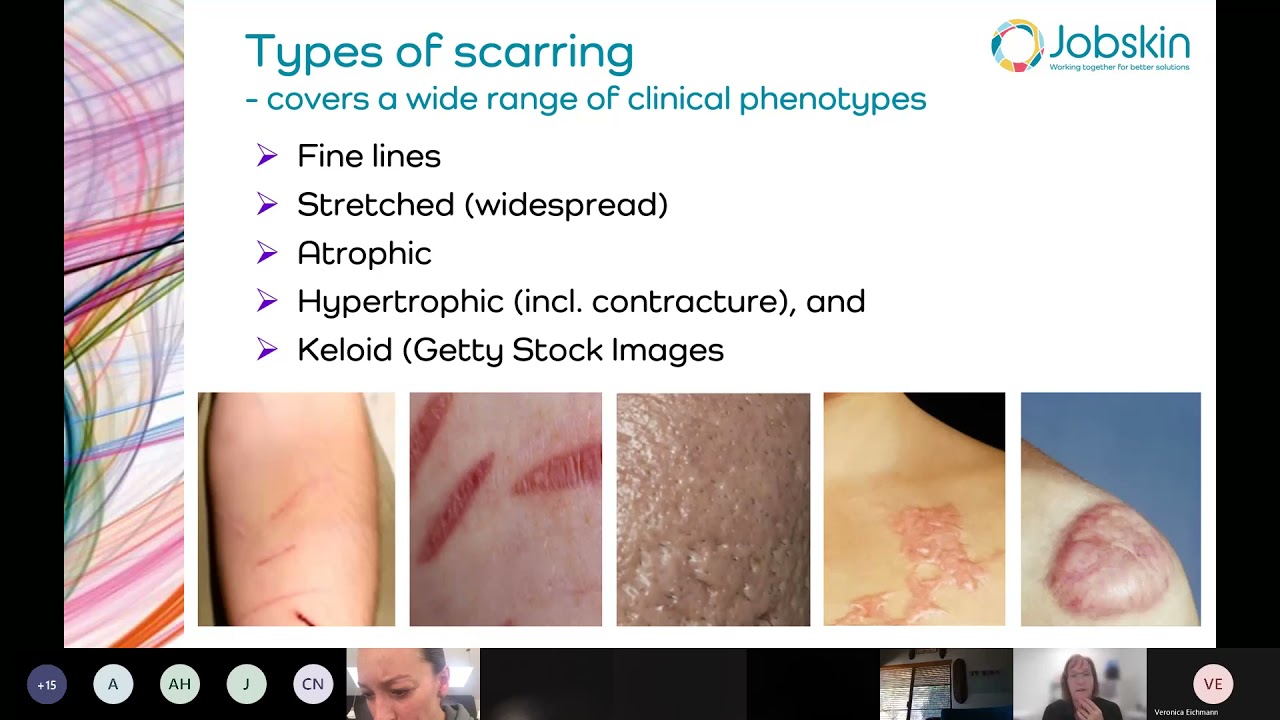 Jobskin Webinar - Compression for Scar Management - YouTube