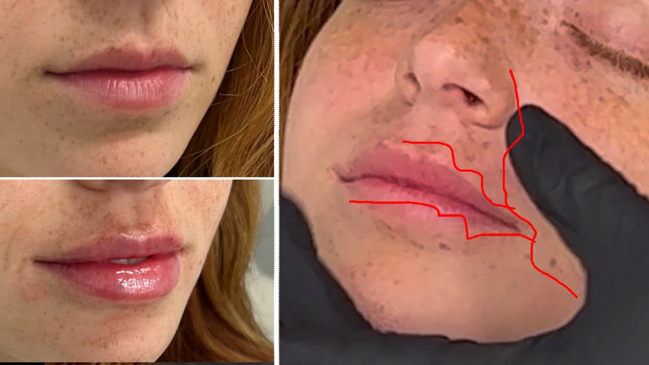 Lip Fillers: Julie Horne’s technique, with a slight modification. - YouTube