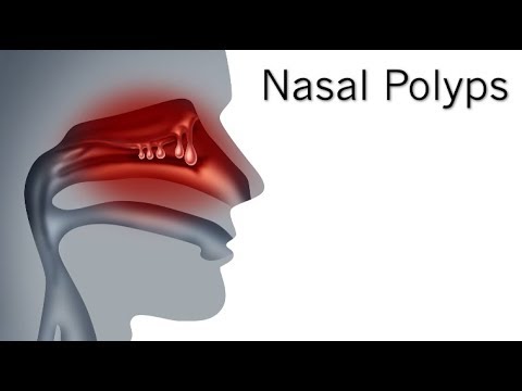 How To Get Rid Of Nasal Polyps For Good