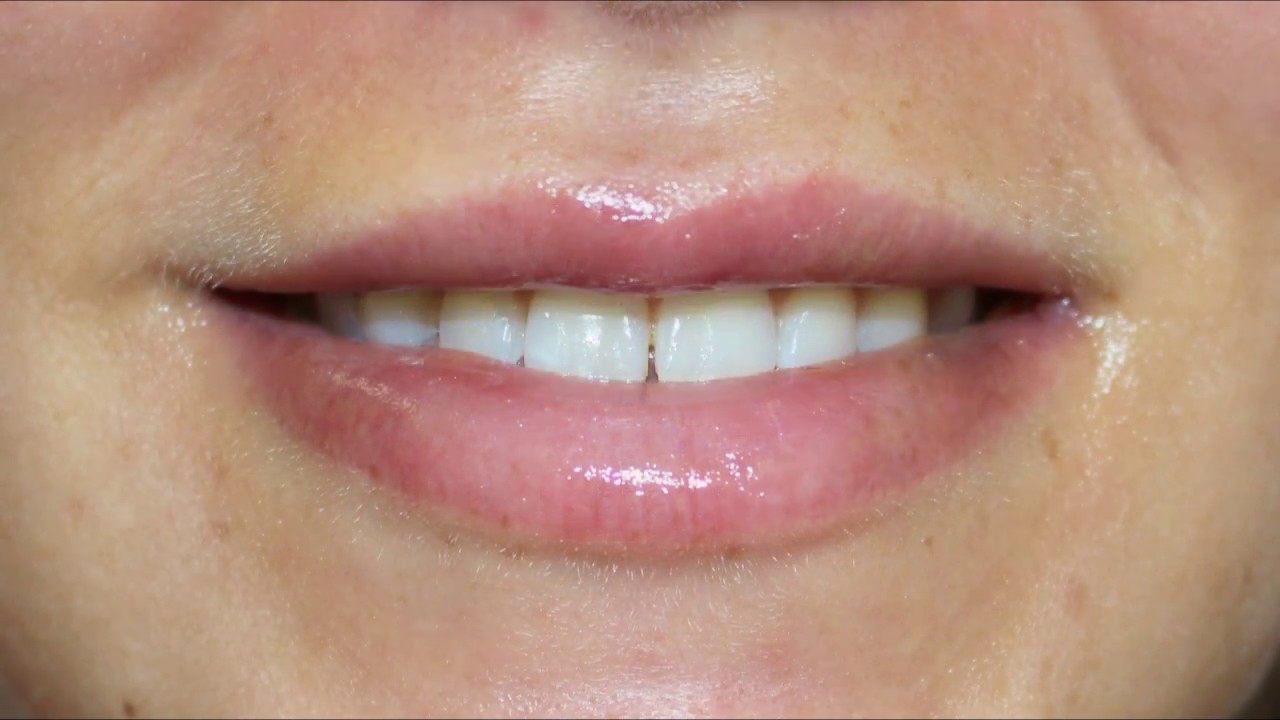 Lip Augmentation with Permasil Implants - YouTube