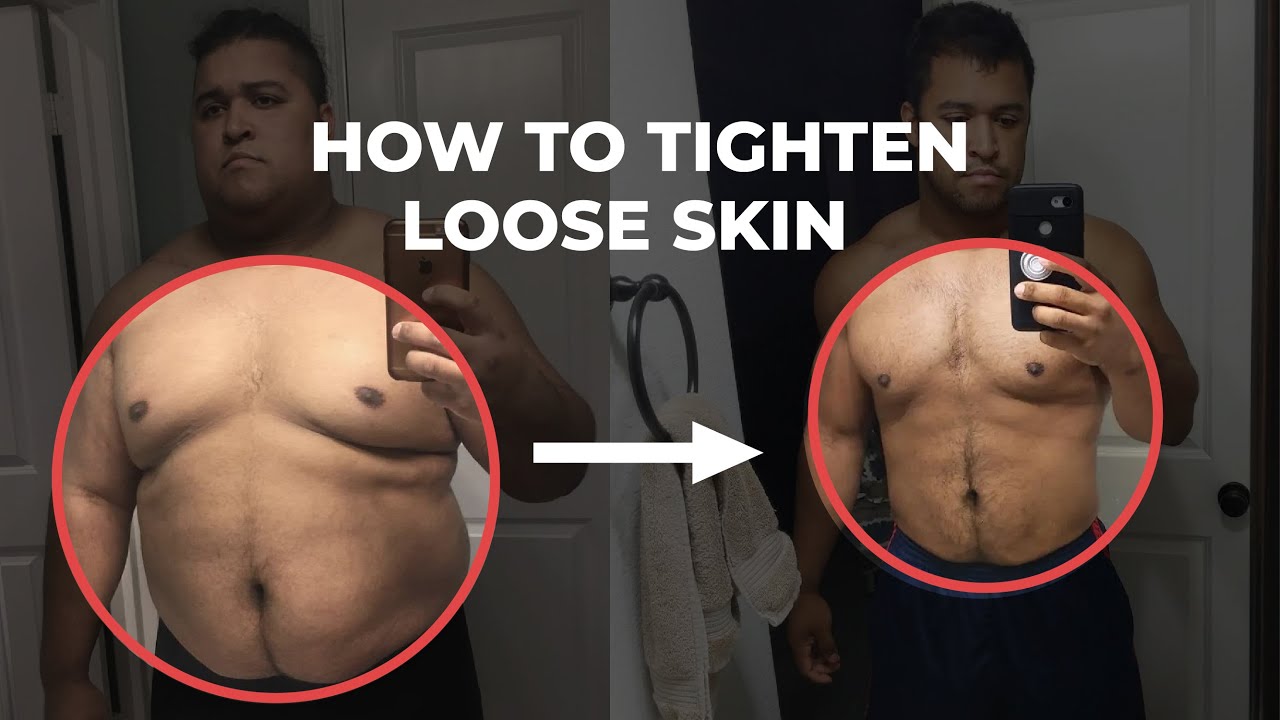 I Lost 175 Pounds & Don't Have Loose Skin. Here's Exactly How. - YouTube