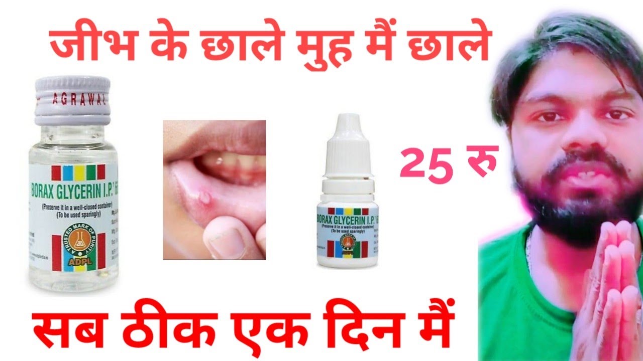 borax glycerin |borax glycerin uses|mouth ulcers |mouth ulcers gel ...