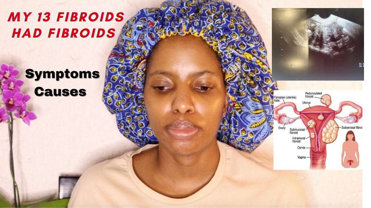 Removing my fibroids: My myomectomy experience - YouTube