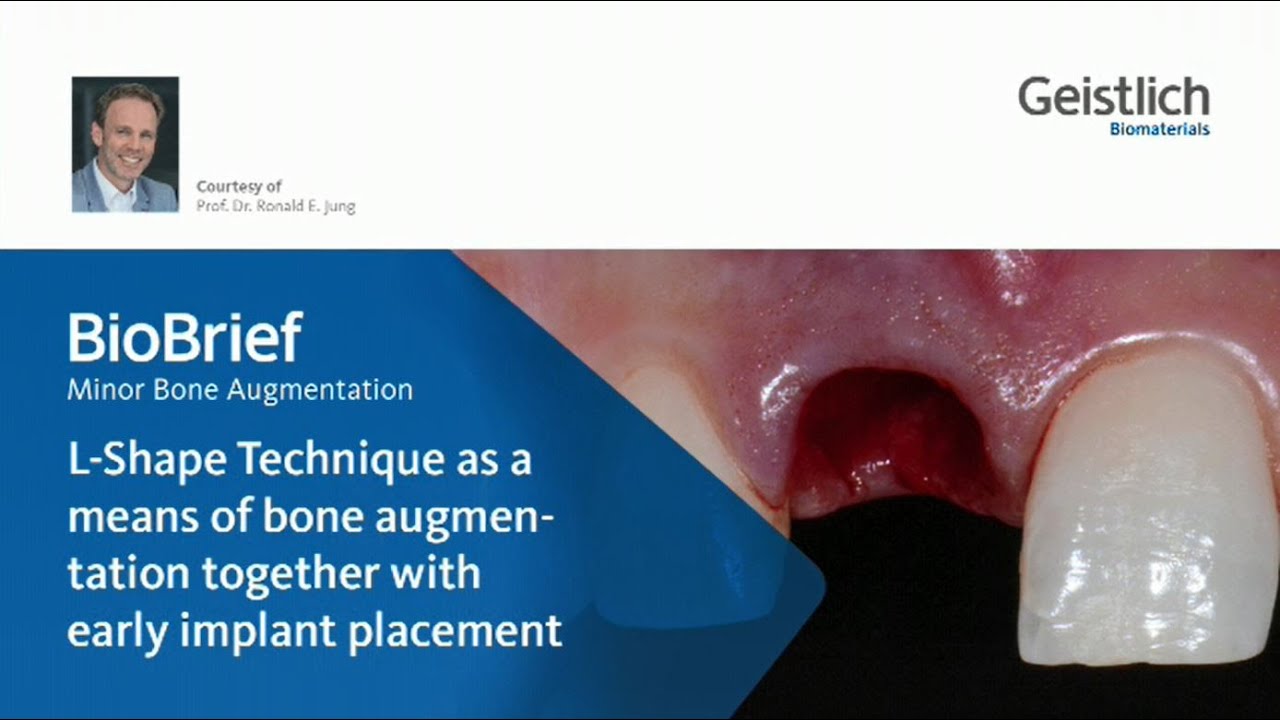 [Geistlich] Minor Bone Augmentation by Dr. Jung - YouTube