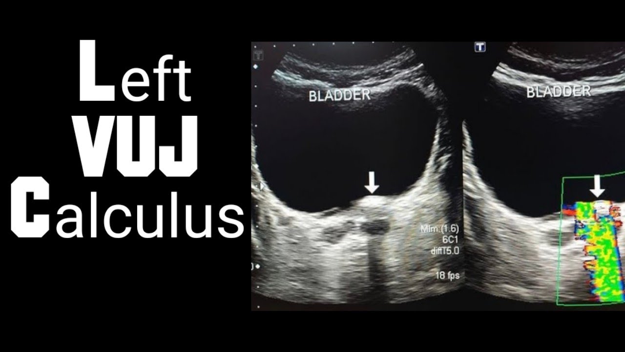 Left VUJ Claculus | Ureteric Stone near Urinary Bladder - YouTube