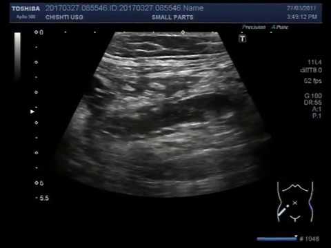 Ultrasound Video showing focusing of inflamed Appendix. - YouTube