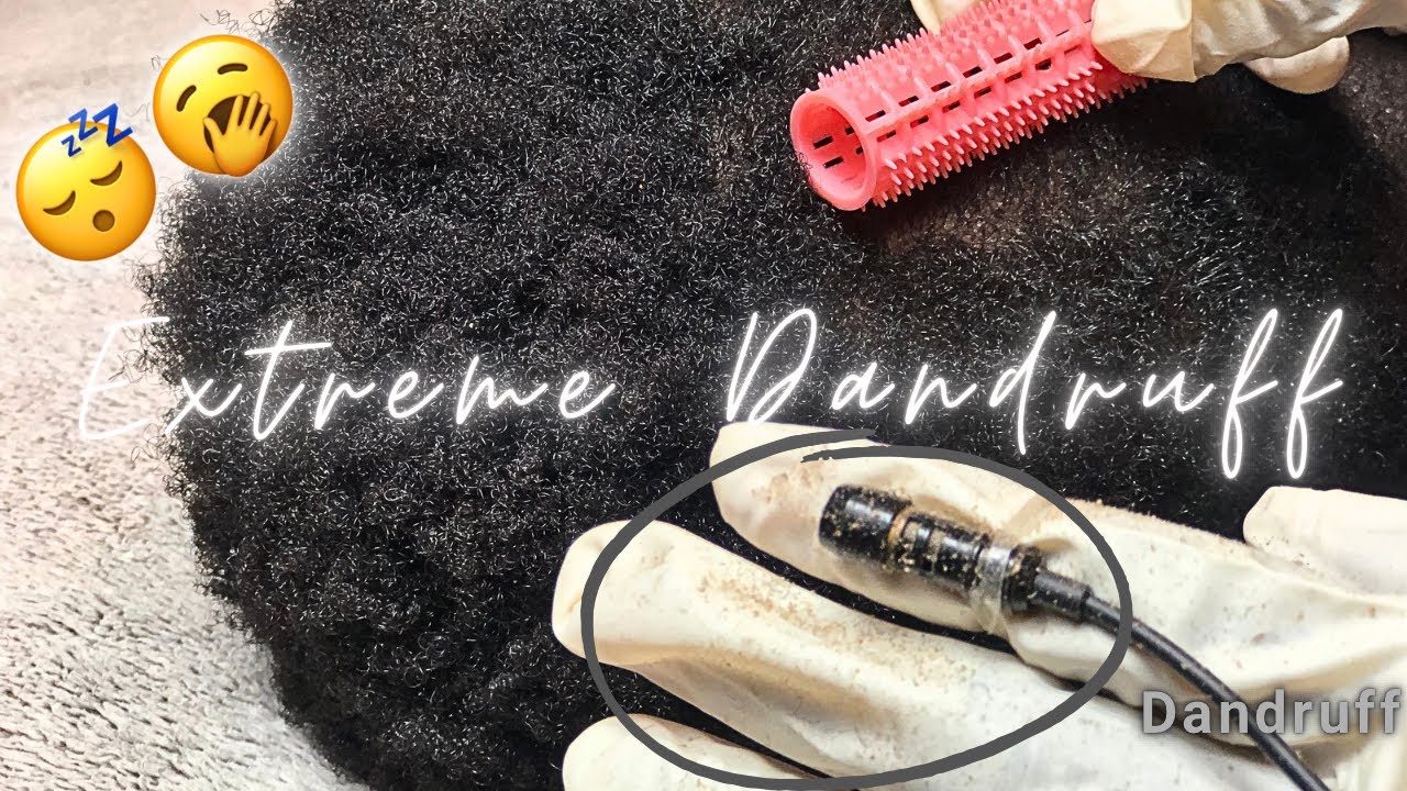 ASMR SCALP SCRATCHING WITH THREE DIFFERENT COMBS || EXTREME DANDRUFF ...