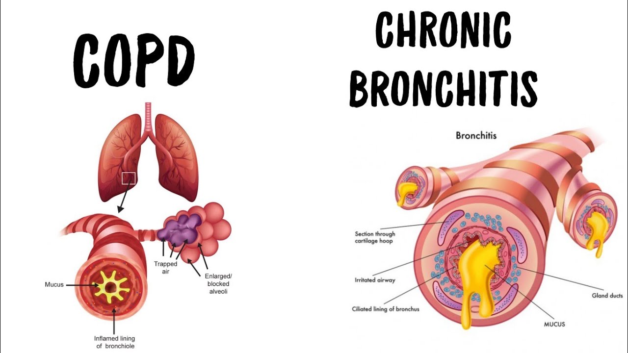 Lecture 19: COPD & CHRONIC BRONCHITIS | RESPIRATORY PATHO | FA USMLE ...