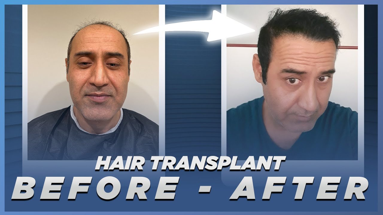 Hair Transplant Before and After: 10 Months Transformation Time Lapse ...