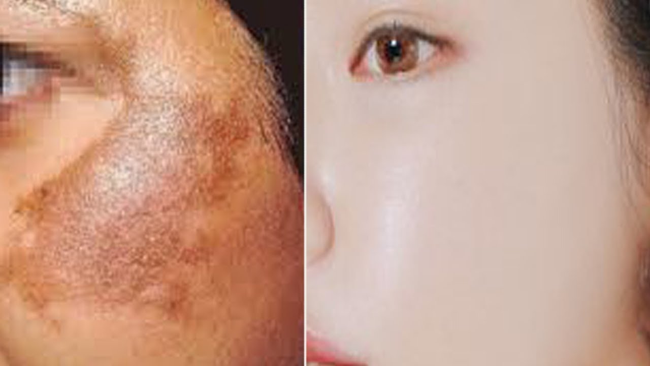 In 3 Days Remove Pigmentation, Dark Spots and Acne Scars | Get 100% ...