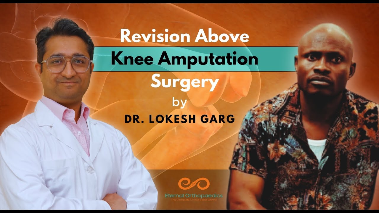 Revision Above Knee Amputation Surgery by Dr. Lokesh Garg - YouTube