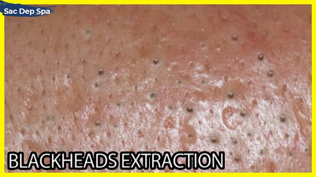 Big Cystic Acne Blackheads Extraction Blackheads And Milia Sac Dep Spa 02 Youtube