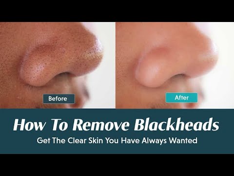 How to remove blackheads from nose | extraction blackhead on nose # ...