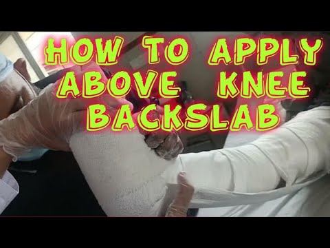 How to apply above knee backslab| kacha plaster kis tarah Igta ...