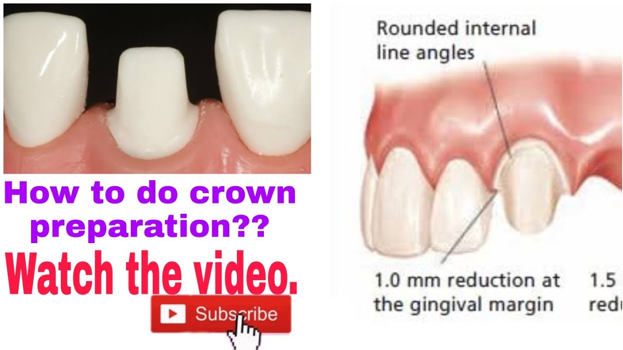 Anterior teeth crown preparation for beginners. Easy crown preparation ...