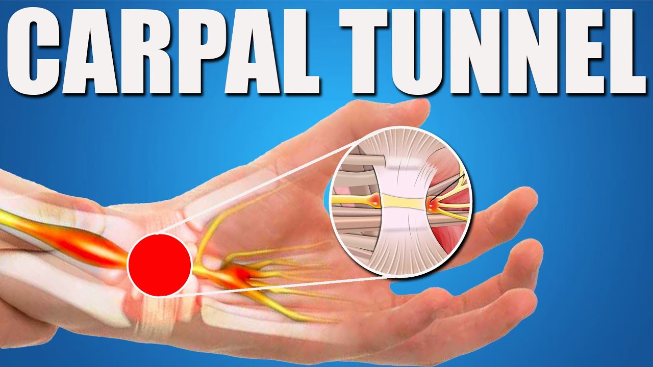 How to FIX Hand Pain from Carpal Tunnel Syndrome. Best Stretches ...