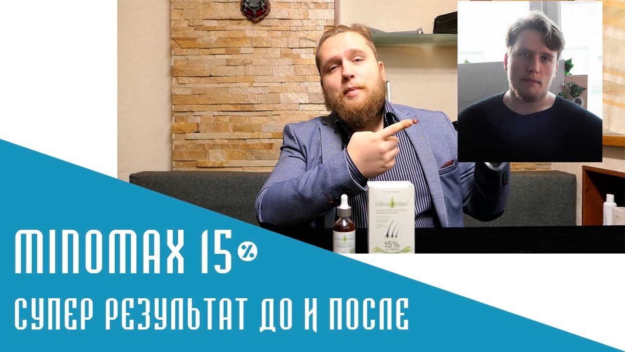 MINOMAX 15% (ДЛЯ РОСТА ВОЛОС) - ЛИЧНЫЙ РЕЗУЛЬТАТ "ДО" И "ПОСЛЕ ...
