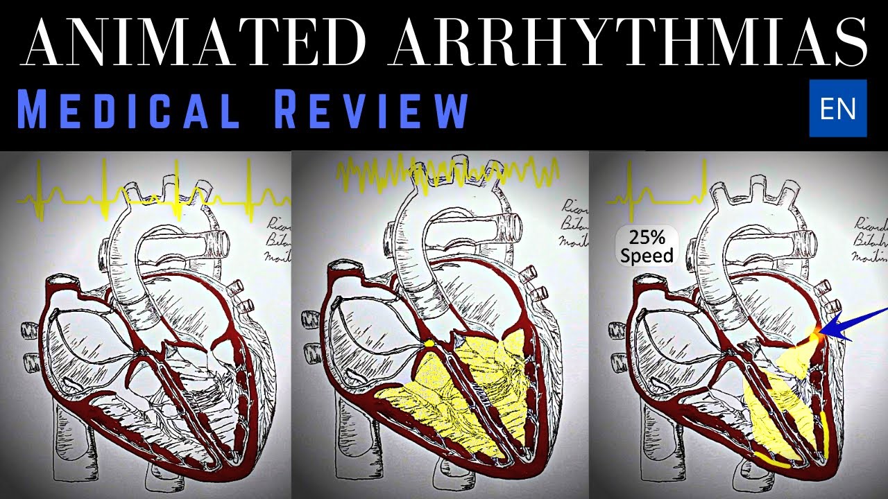 A Visual Explanation of Cardiac Arrhythmias - YouTube