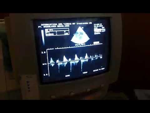 Ultrazvuk srca - YouTube