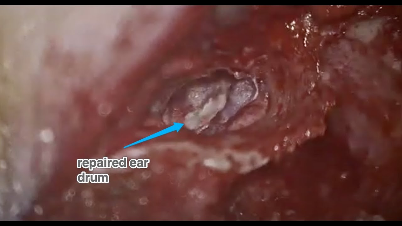 Concha cymba underlay cartilage tympanoplasty - YouTube
