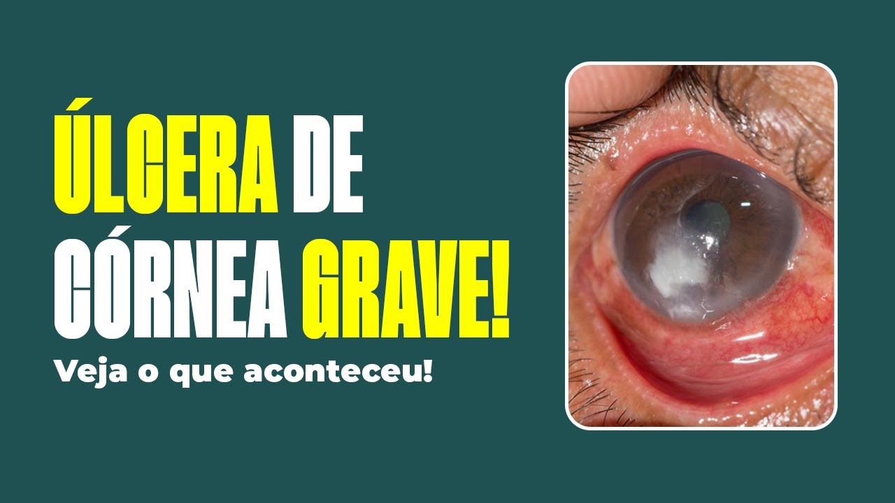 Úlcera de córnea grave Veja o que aconteceu - YouTube