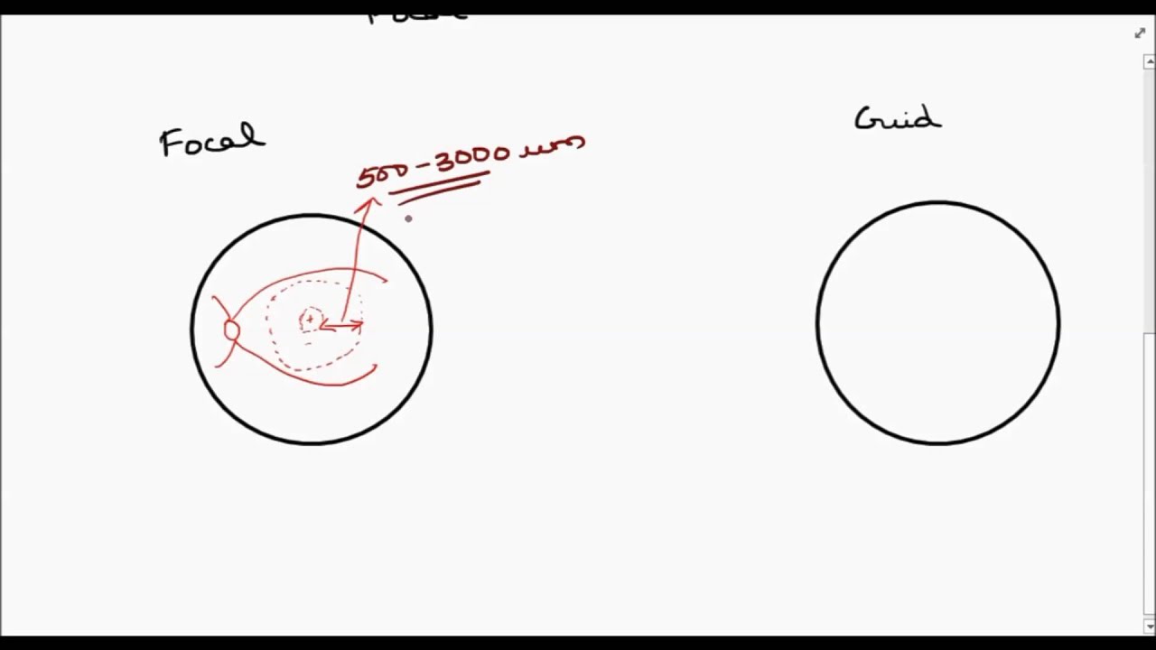 csme treatment - YouTube