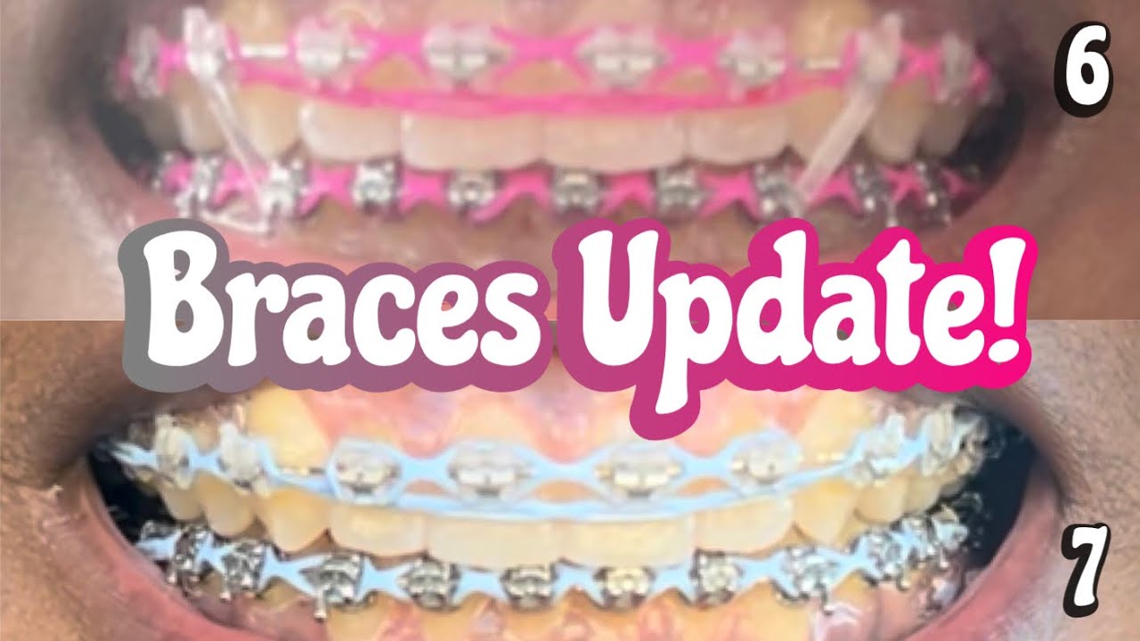 1 YEAR BRACES UPDATE!! | 7th Adjustment - YouTube