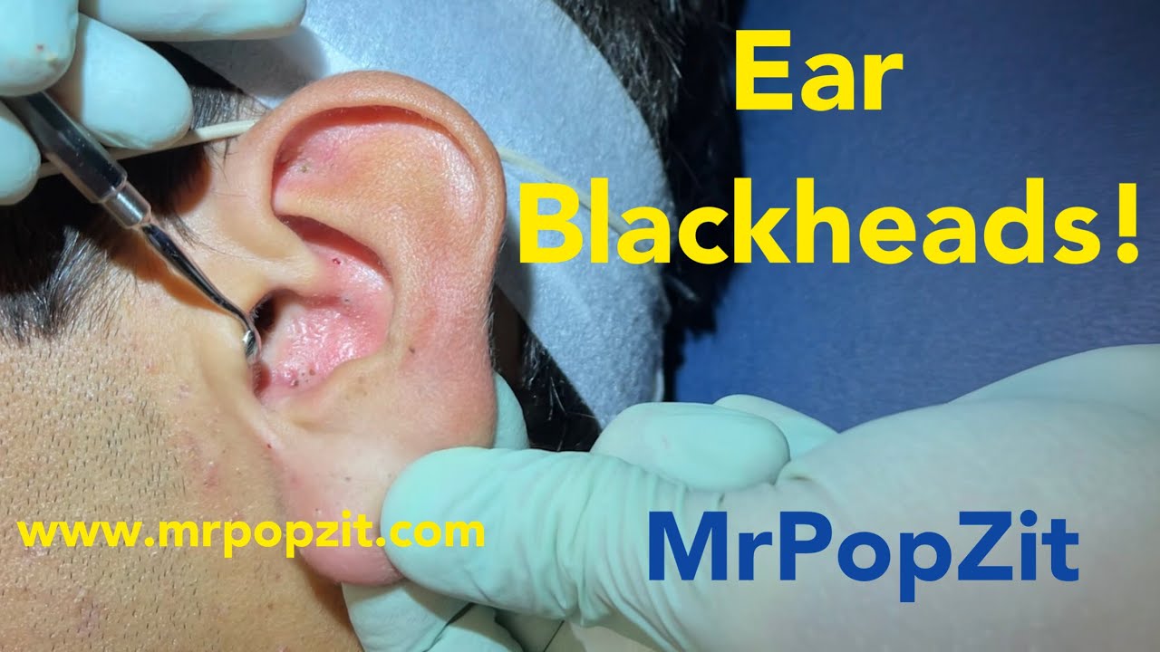 Ear Blackheads and more! Tricky extractions deep in the ear. Many waxy ...