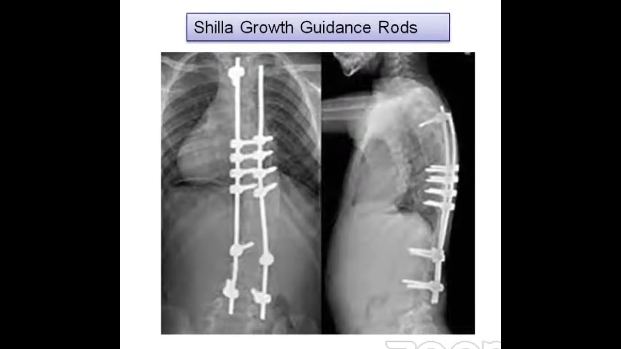 Evolution of Instrumentation in Scoliosis - YouTube