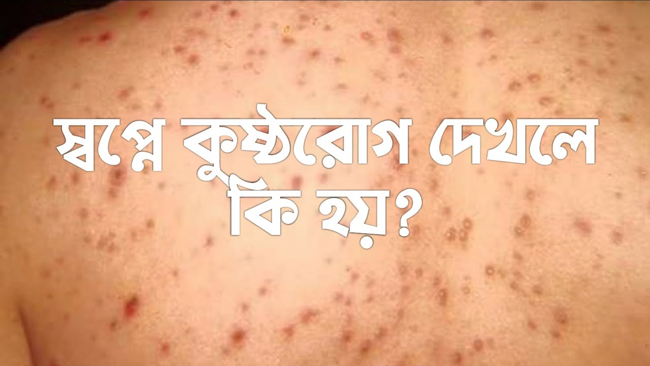 স্বপ্নে কুষ্ঠরোগ দেখলে কি হয় | swapne kustho rog dekhle ki hoy ...