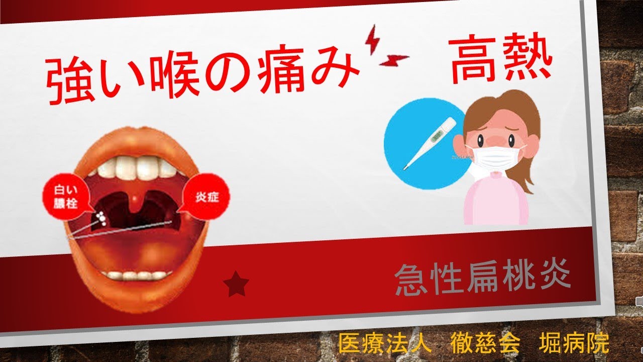 強い喉の痛み ・ 高熱 急性扁桃炎 Youtube