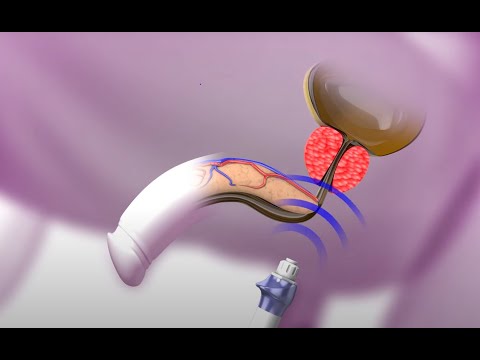 Prostate Disorders Treatment - BTL Shockwave Therapy