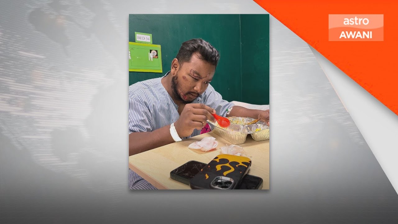 CEO Batu patah gigi, terima 20 jahitan di kepala kerana kemalangan ...