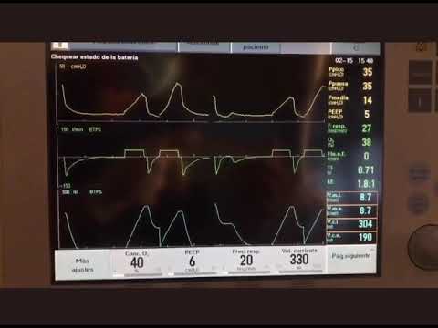 Doble disparo. Asincronía. Ventilación mecánica - YouTube
