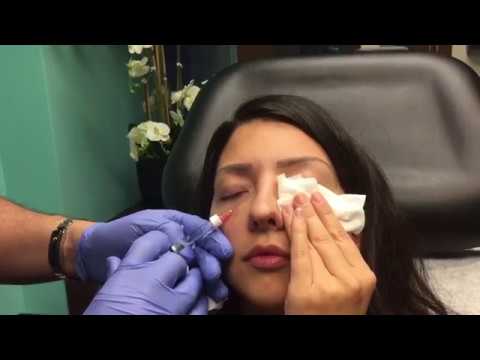 Tear Trough Touch Up Injection - YouTube