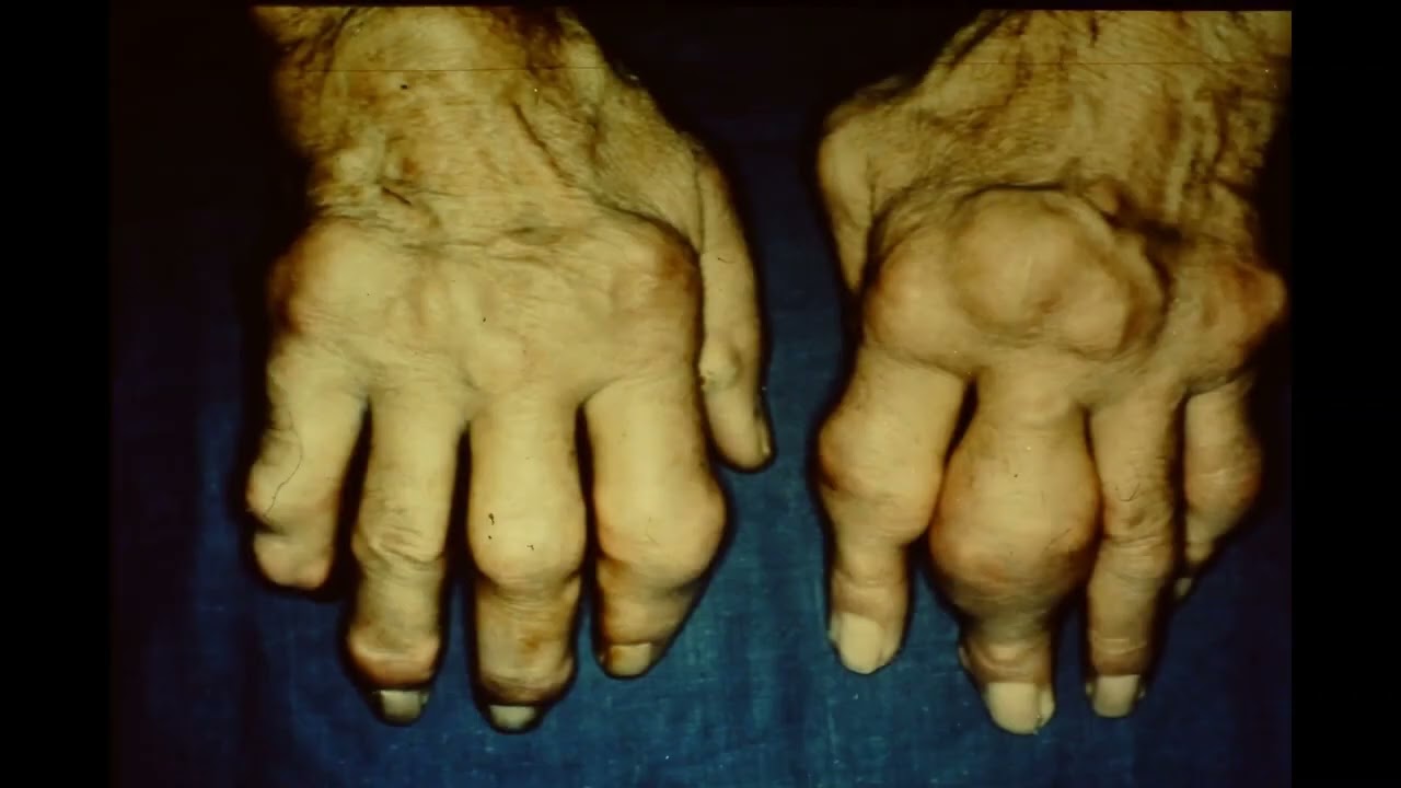 Images of Gout - YouTube