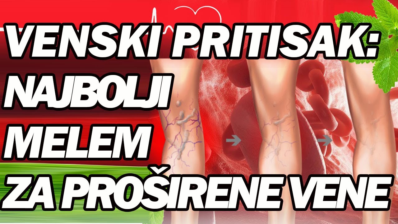 PROŠIRENE VENE - ISCJELJENJE U DVA KORAKA! Dr Mihajlović - YouTube
