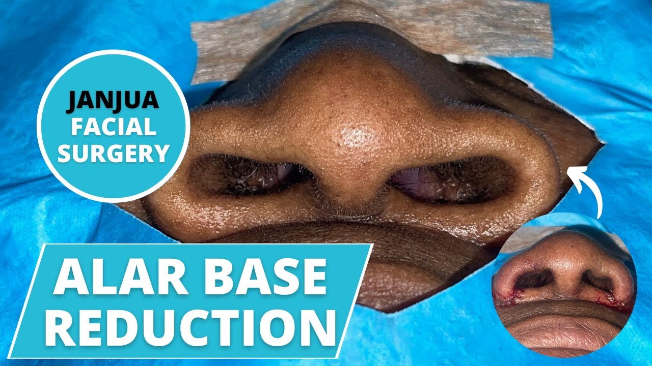 ALAR BASE REDUCTION (ALARPLASTY) - DR. TANVEER JANJUA - NEW JERSEY ...