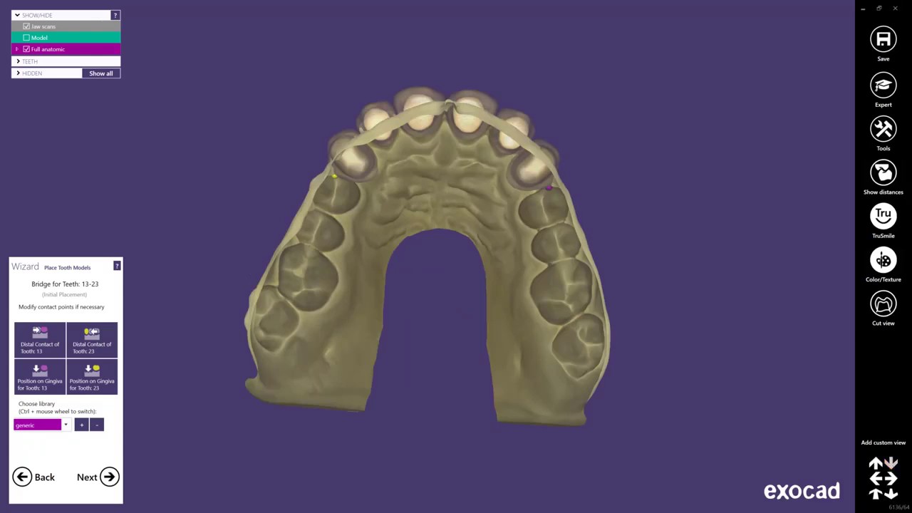 How to create a Digital Waxup Model with exocad DentalCAD 2016 and ...