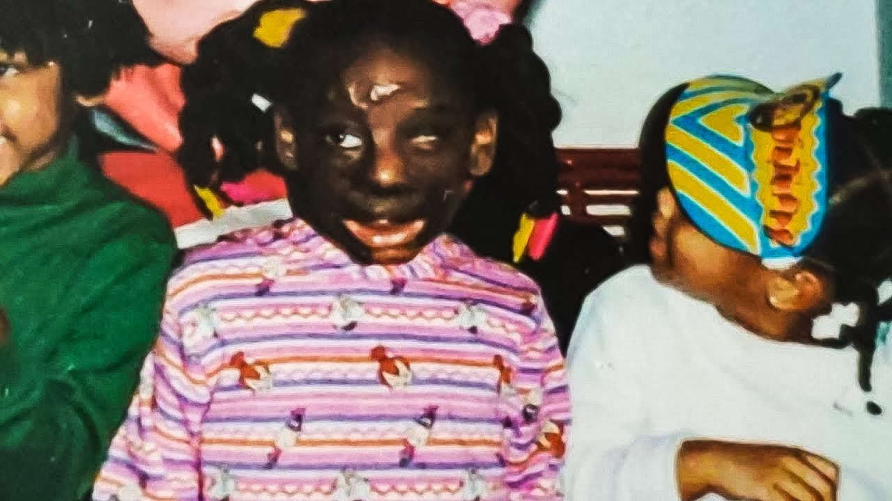 Burn survivor branded 'MONSTER' refuses to get surgery but at 30 - YouTube